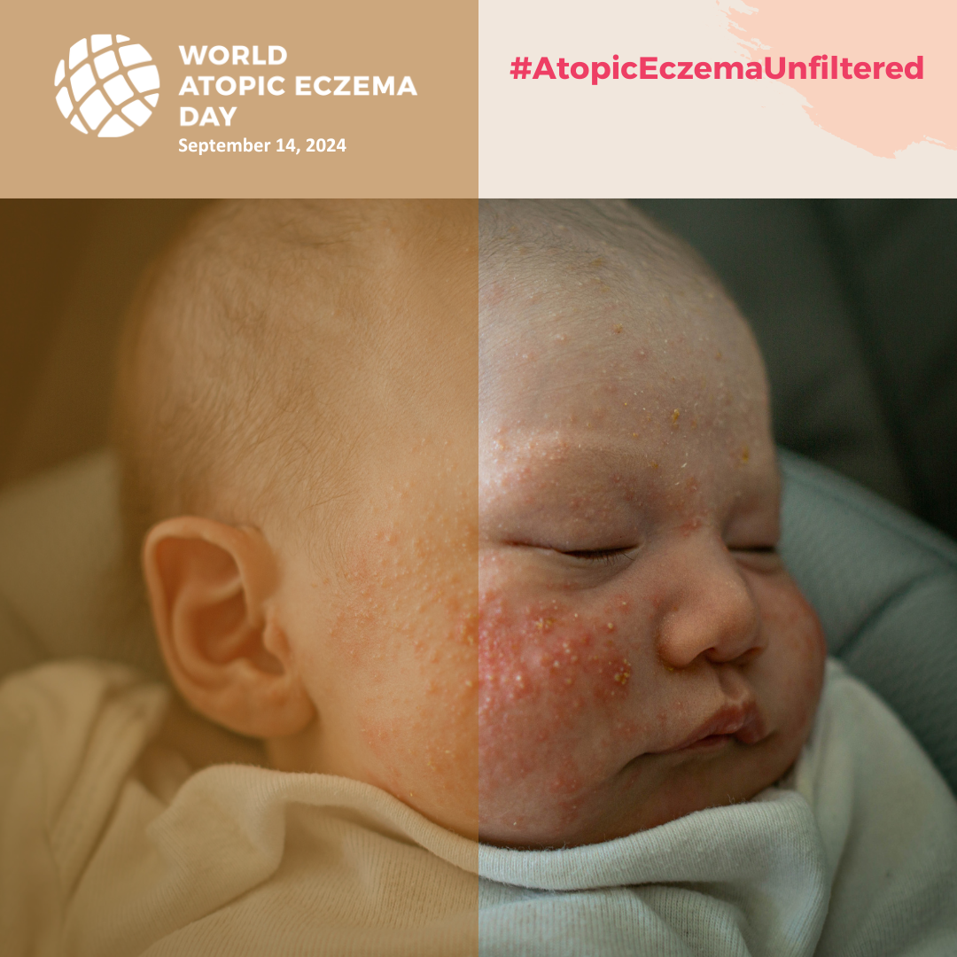 World Atopic Eczema Day Fund